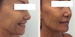 Facial Volume Loss - The Cosmetic Clinic