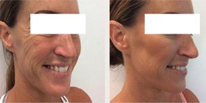Facial Volume Loss - The Cosmetic Clinic