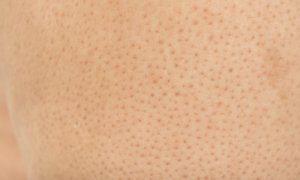Enlarged Pores - The Cosmetic Clinic