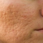 Scars - The Cosmetic Clinic