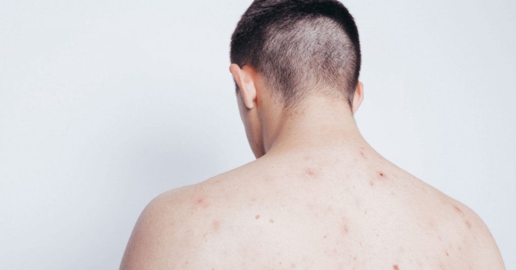 Back Acne / Pimples - The Cosmetic Clinic