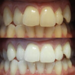 Teeth Whitening - The Cosmetic Clinic