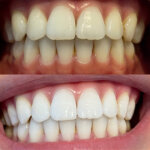 Teeth Whitening - The Cosmetic Clinic