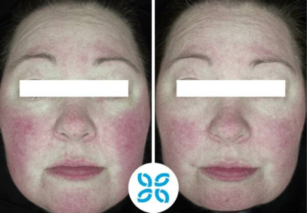 Lumixa Light Therapy - The Cosmetic Clinic